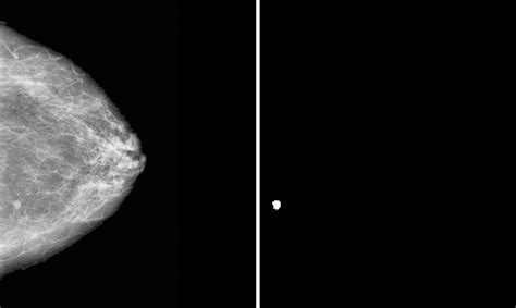 ai on mammogram minnovaa