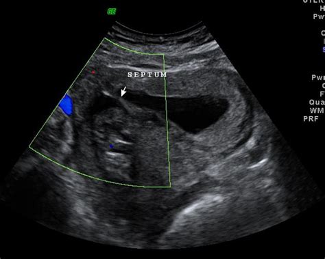 Arcuate Uterus Ultrasound