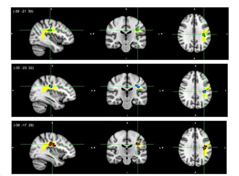 Left Slfaf White Matter Microstructure Differences Lower Fa Green Download Scientific