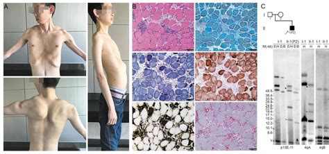 Clinical And Genetic Features Of Somatic Mosaicism In