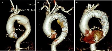 The Cta Of The Aorta Before And After The Tevar A Before Tevar B