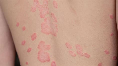 Some Psoriasis Biologics Better Than Others For Preventing Progression
