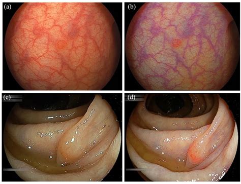 Linked Color Imaging For The Detection Of Early Gastrointestinal Neoplasms Pmc