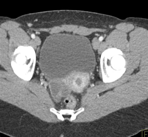 Theca Luteum Cyst