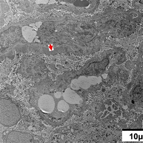 Electron Microscopy Revealed Electron Dense Deposits Edds Black