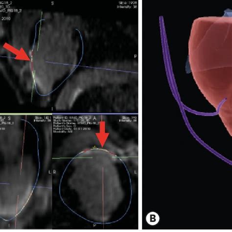 Preprocedural Imaging Of Scar A Lge Mri 3 Dimensional Reconstruction Download Scientific