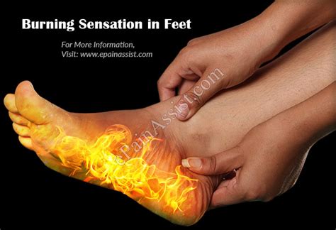 Burning Sensation In Feetcausestreatmentpreventiondiagnosis