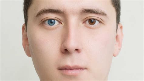 Heterochromia Causes Diagnosis And Treatment Accuspire