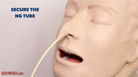 Nasogastric Ng Tube Insertion Osce Guide 52 Off