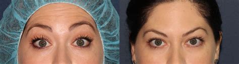 Before And After Botox Injections To Treat Forehead Wrinkles By Dr