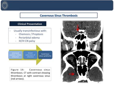 Cavernous Sinus Thrombosis