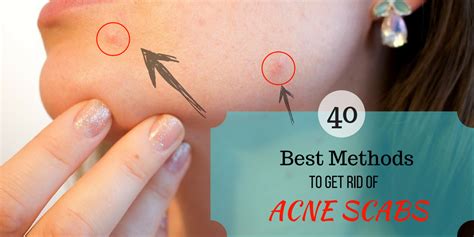 40 Best Ways To Get Rid Of Acne Scabs Overnight Diy Home Remedies