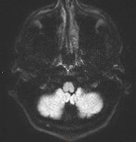 File Diffuse Astrocytoma IDH Mutant Radiopaedia Axial NC Commons