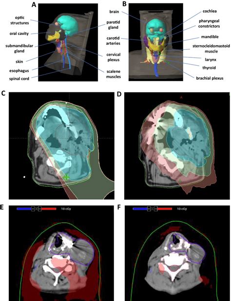 A B Organs At Risk” For Radiotherapy Of The Head And Neck In A