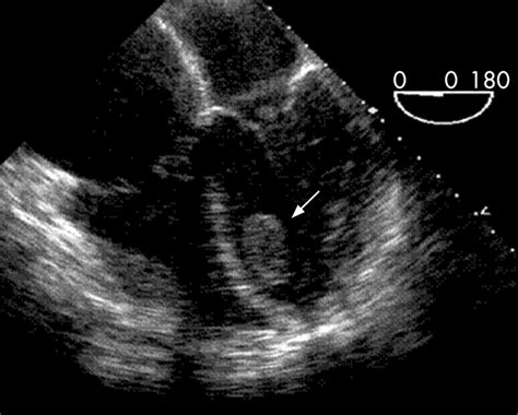 Management Of Lv Thrombus Paul Smith