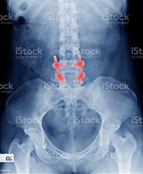 Xray Punggung Bawah Pemuda Pasca Tetap Patah Tulang Belakang Lumbar