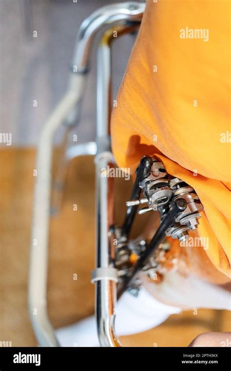 Above View Of External Fixation Device On Hip And Pelvic In Patient