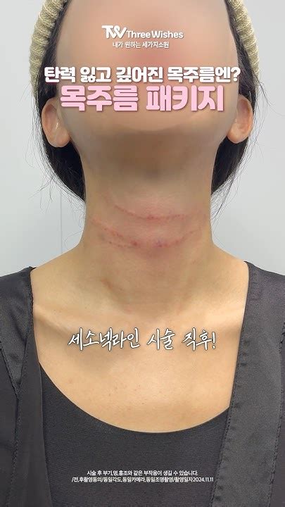세소만의 목주름 패키지 4가지 시술로 목피부 광명찾쟈 💗 목주름 탄력 피부탄력 피부관리 필러 주름필러 리프테라