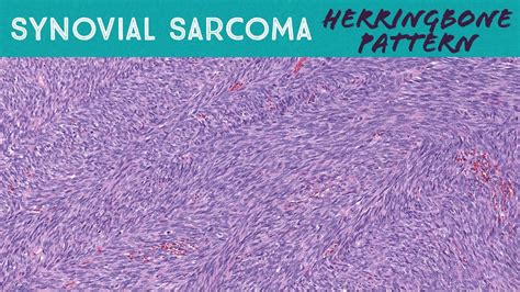 Herringbone Pattern Histopathology At Paul Caison Blog