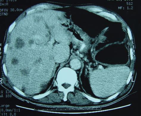 Multislice Computed Tomography 128 Slice Lifemed