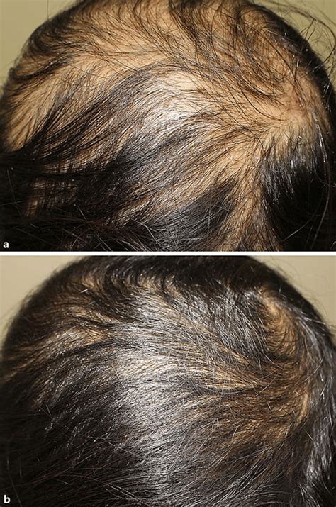A Significant Improvement In Terms Of Decreased Scalp Inflammation And Download Scientific
