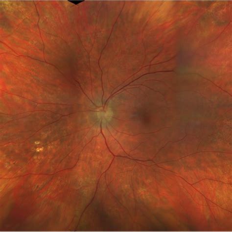 Neovascular Complications A Left Eye With Neovascularization Of Disc