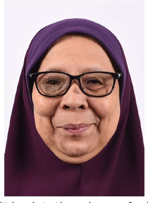 Figure 10 From Prosthetic Rehabilitation On Patient With Orbital Defect A Customised Approach