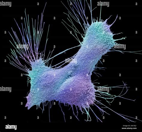 Prostate Cancer Cells Coloured Scanning Electron Micrograph Sem Such Cells Can Clump To Form