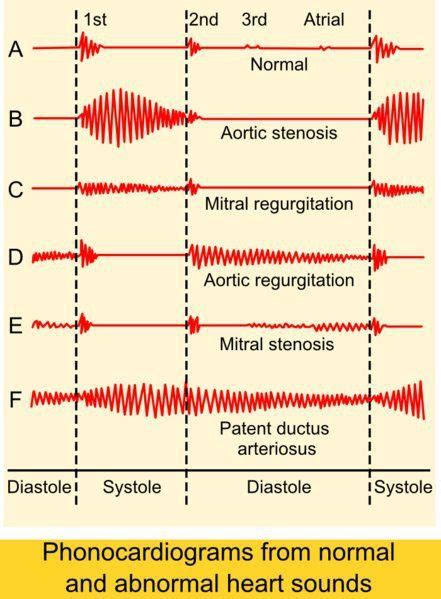 Murmurs • Aortic Stenosis Mid Systolic In Crescendo Decrescendo