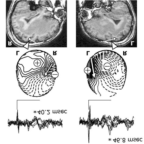Epileptiform Discharges In Case 2 EEG Showed Sporadic Spikes In The Download Scientific