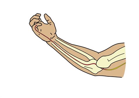 La Compression Du Nerf Ulnaire Uneos