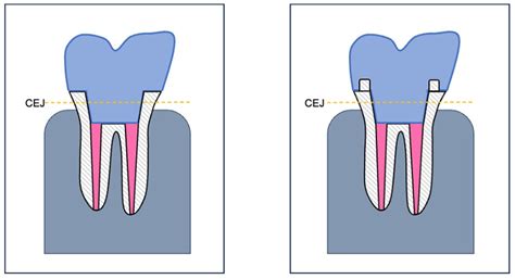 Influence Of Cementation Mode And Ferrule Design On The Fatigue