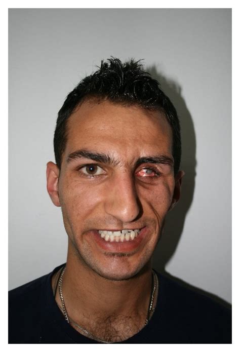 A Atrophy And Fissuring Of The Left Hemiglossus B Maxillary Download Scientific Diagram