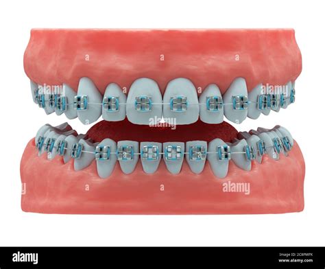 Metal Bracket Braces