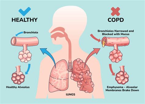 Copd Lung Cancer