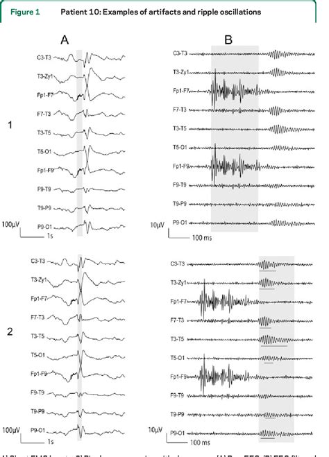 figure 3 from interictal scalp fast oscillations as a marker of the seizure onset zone