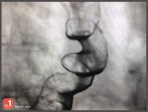 Diffuse Esophageal Spasm Nursing Times