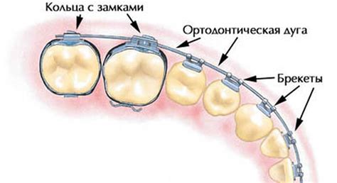 Брекет-системы в СПб: установка современных видов брекетов по выгодным ...