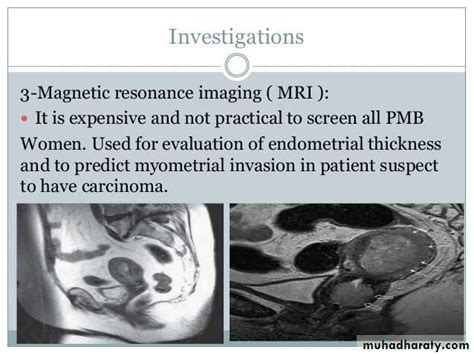 Post Menopausal Bleeding Pptx D Marwa Muhadharaty