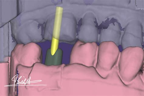 Full Dentistry Workflow Of Implant Case SHINING D Dental