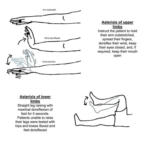 Neurological Assessment Of Asterixis Of The Upper And Lower Limbs