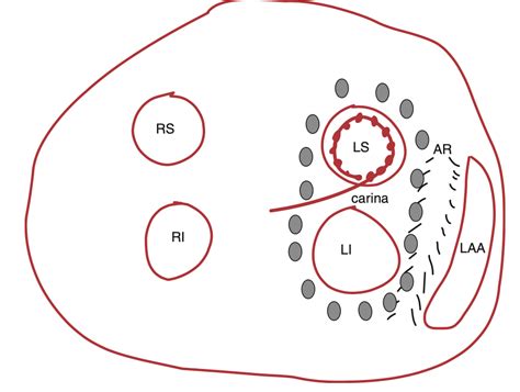 Left Sided Pulmonary Vein Isolation Diagram Quizlet