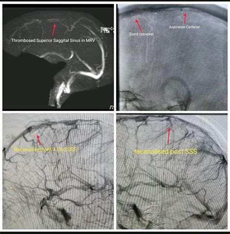 Thrombectomy In Venous Stroke Superior Saggital Sinus Thrombosis Presenting With Sudden