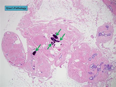 Qiaos Pathology Microcalcifications In Benign Breast Tis… Flickr