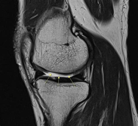 무릎연골손상 치료 관절경을 이용한 자가골연골이식술 네이버 블로그
