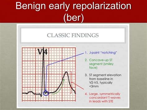Atypical Stemi Patterns And Stemi Equivalents Pptx Heart And