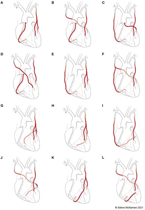 Total Arterial Grafting Configurations A Configuration A In Situ