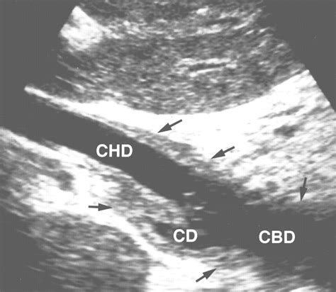 Common Bile Duct Ultrasound
