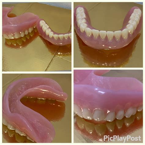 📌 Thermosen Denture Thermo Vital Dental Clinic