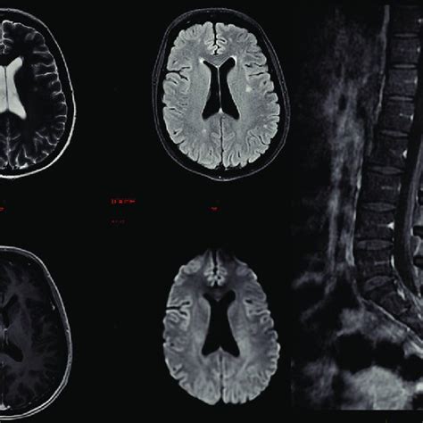 Mri Showed Multiple Punctate Hyperintense Images In T2 And Flair That Download Scientific